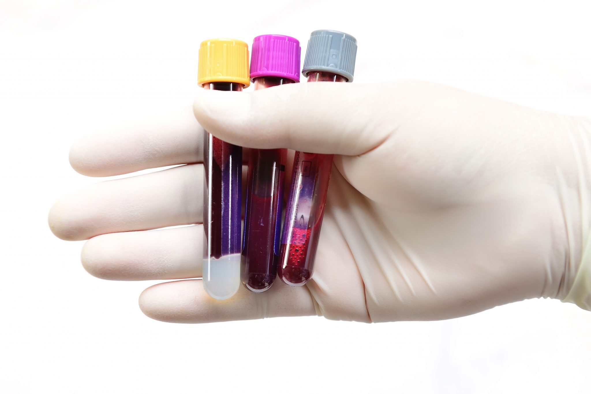 Useful Atrial Fibrillation Tests | Atrial Fibrillation Matters