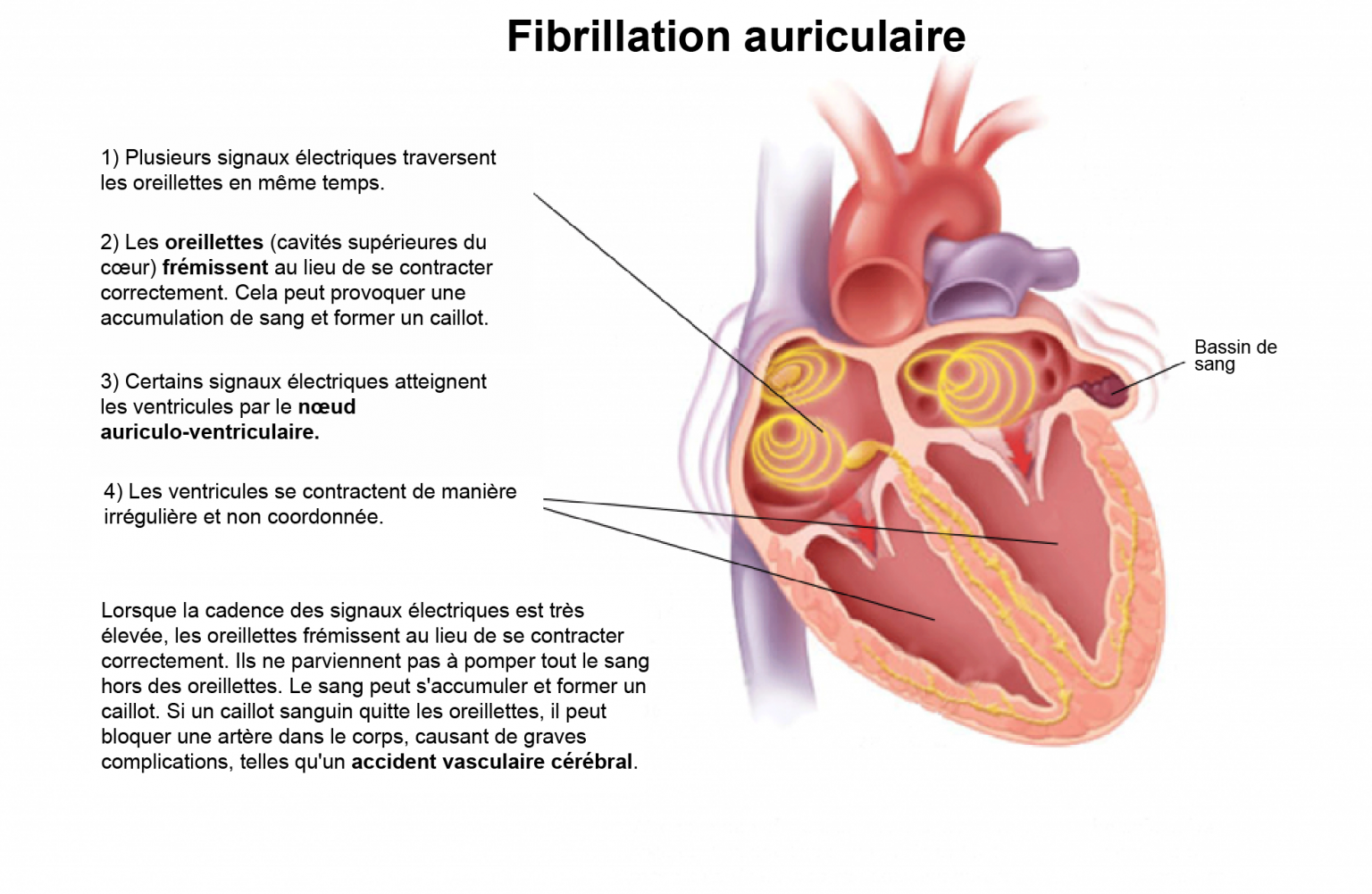 Le cœur pendant la fibrillation atriale | L’importance de la ...