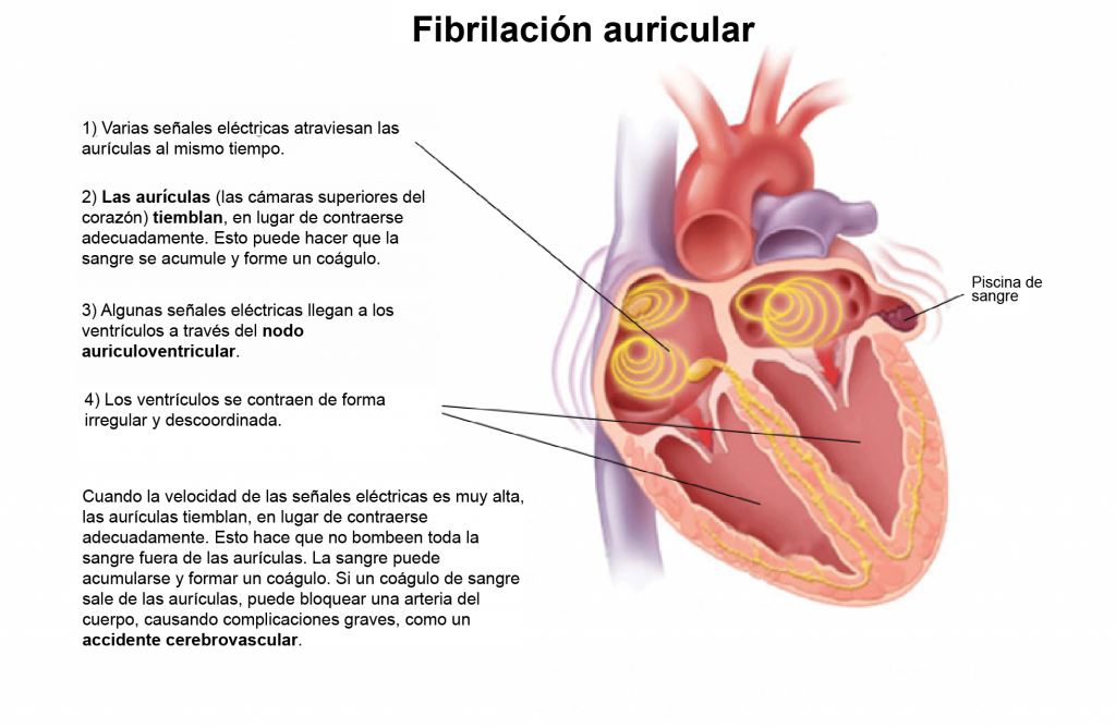 El corazón durante la fibrilación auricular | La fibrilación auricular ...