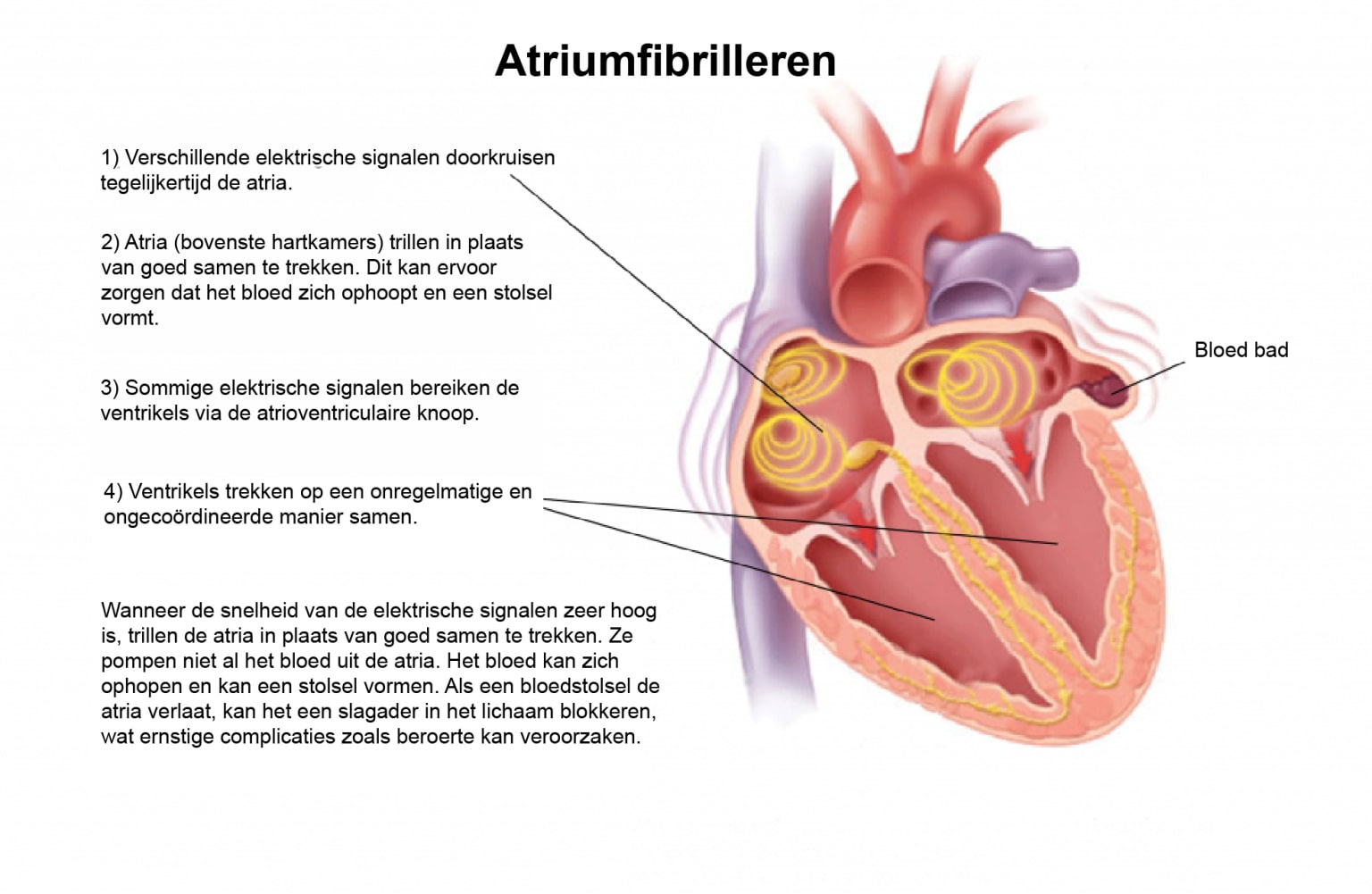 Het hart tijdens atriumfibrilleren | Aandacht voor atriumfibrilleren