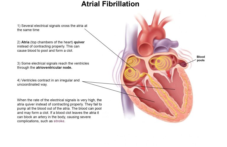 The Heart During Atrial Fibrillation | Atrial Fibrillation Matters