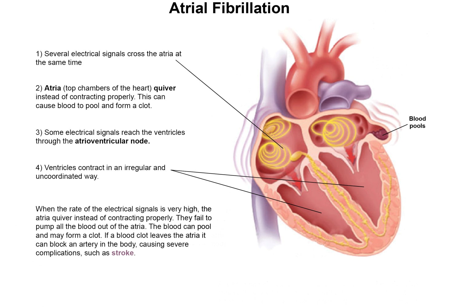 The Heart During Atrial Fibrillation | Atrial Fibrillation Matters